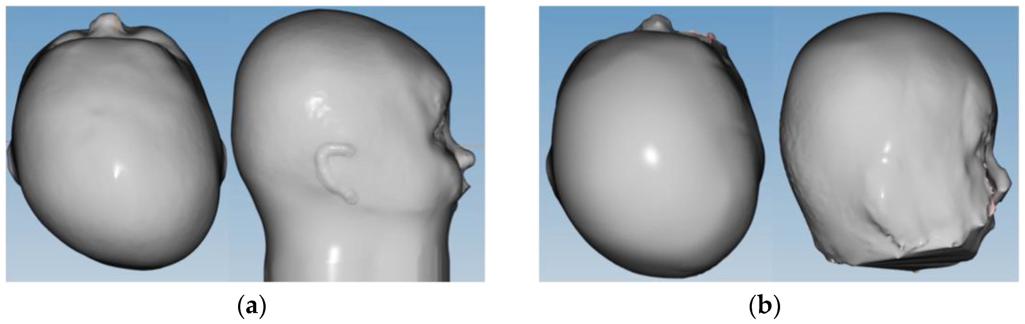 Predictive Value of Sonographic Parameters on the Effects of Cranial Molding Helmet Therapy in ...