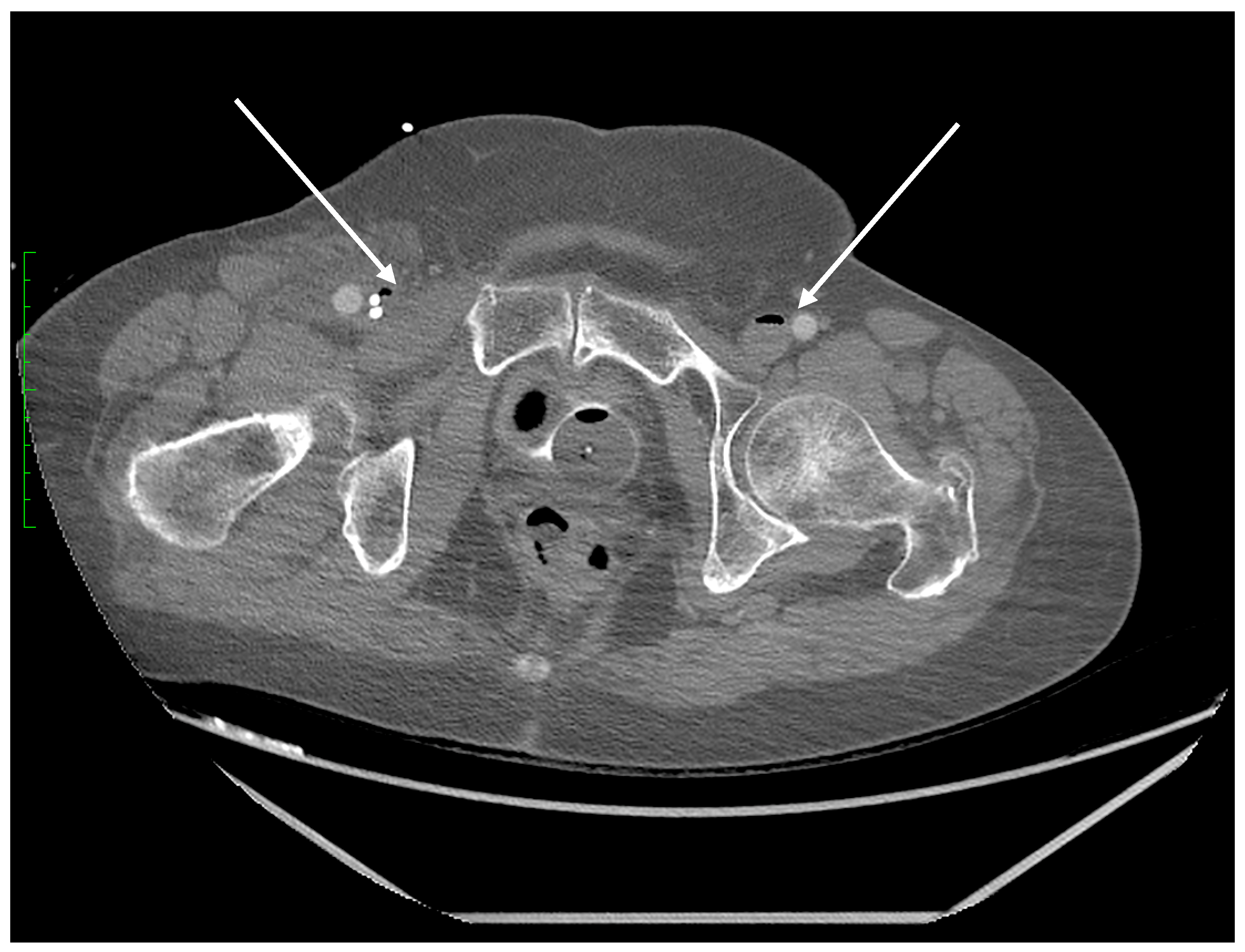 Diagnostics | Free Full-Text | Analysis of Tomographic Images of a Catastrophic Gas Embolism ...