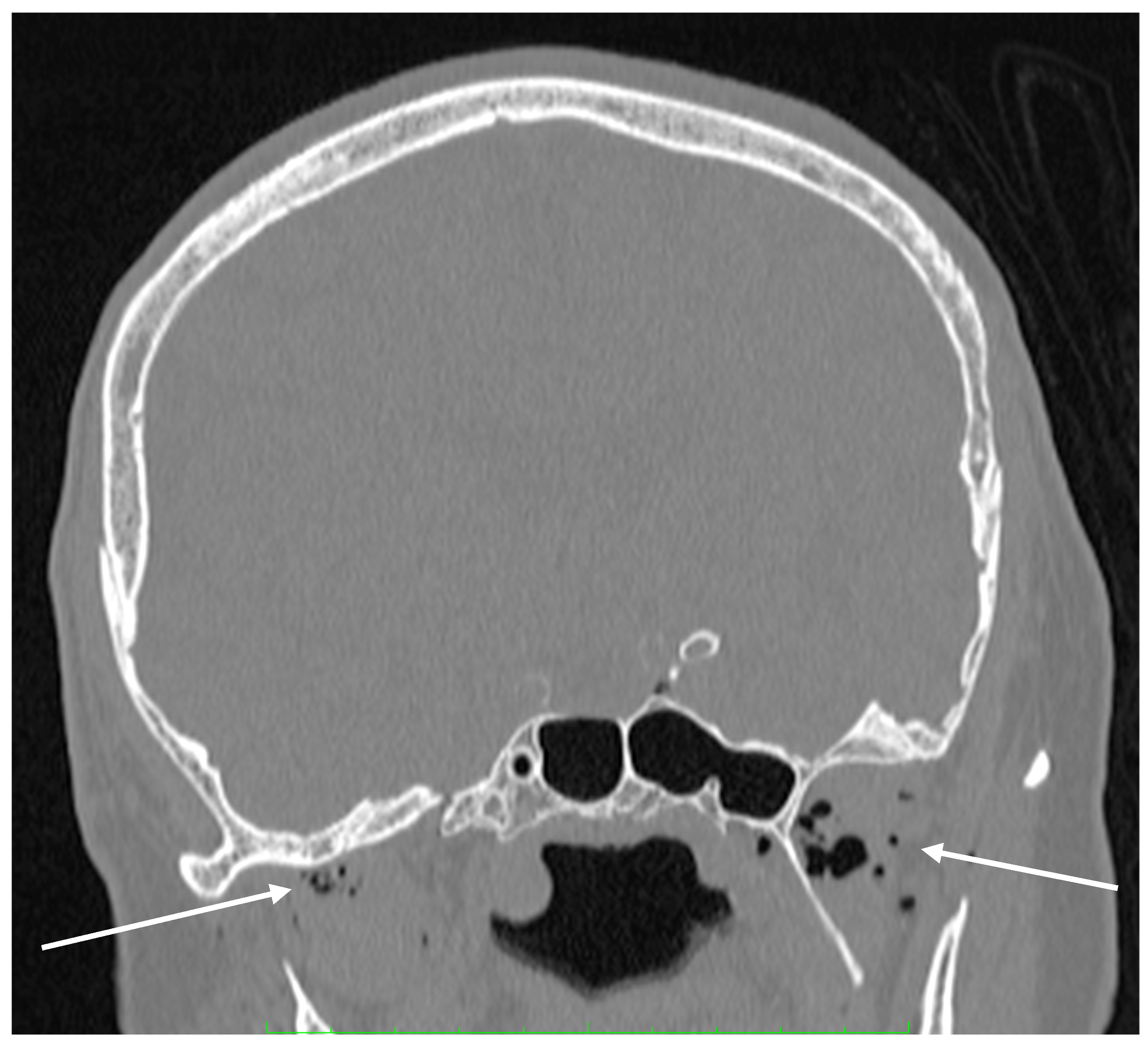Diagnostics | Free Full-Text | Analysis of Tomographic Images of a ...