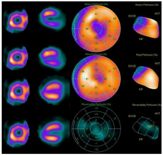 Technological Advances in SPECT and SPECT/CT Imaging