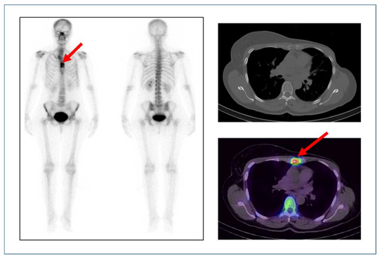 Technological Advances in SPECT and SPECT/CT Imaging