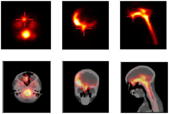 Technological Advances in SPECT and SPECT/CT Imaging