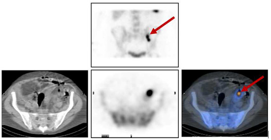Technological Advances in SPECT and SPECT/CT Imaging