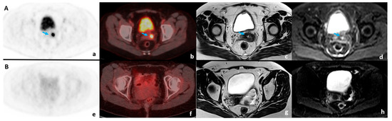 18F-FDG PET/CT- and MRI-Based Locally Advanced Cervical Cancer Early-Response Assessment after ...