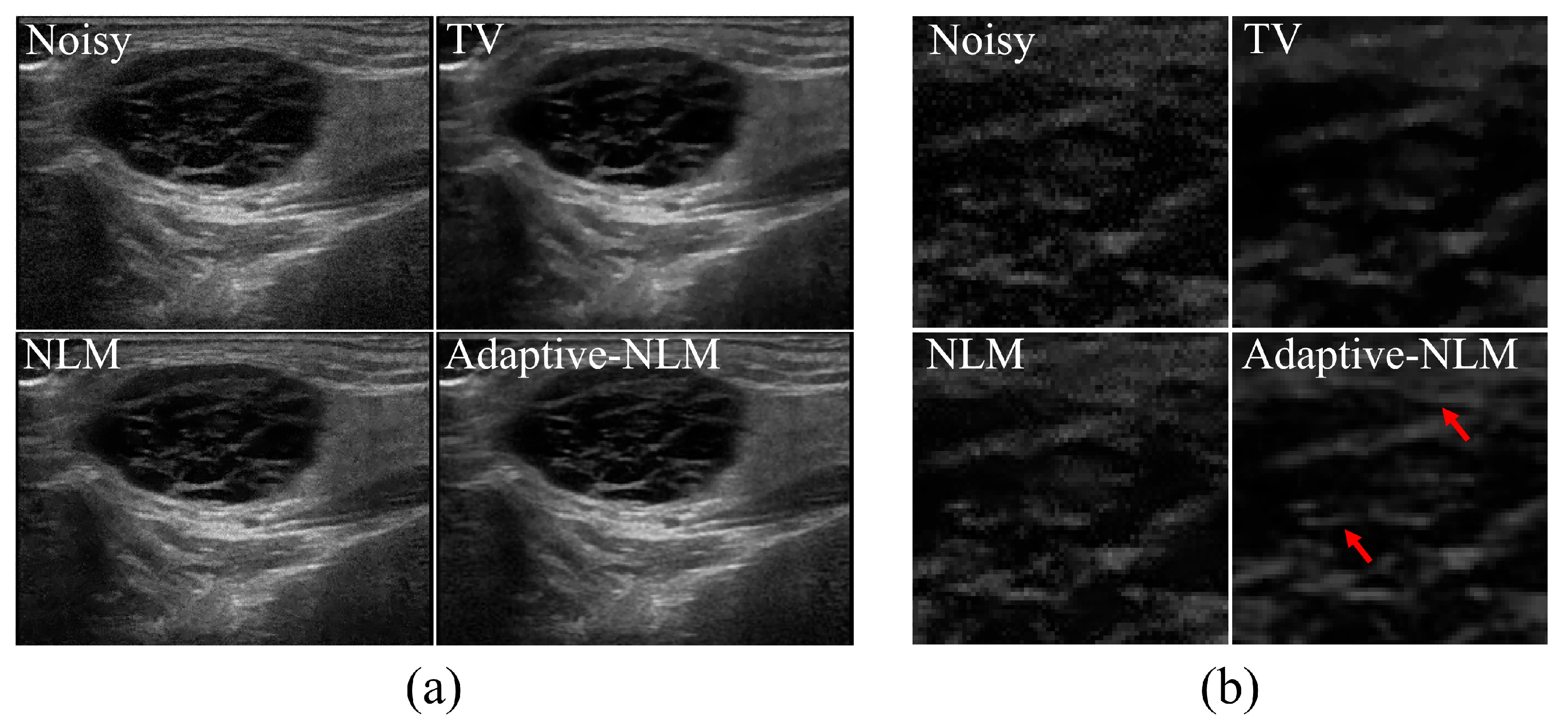 Performance Evaluation of Ultrasound Images Using Non-Local Means Algorithm with Adaptive ...