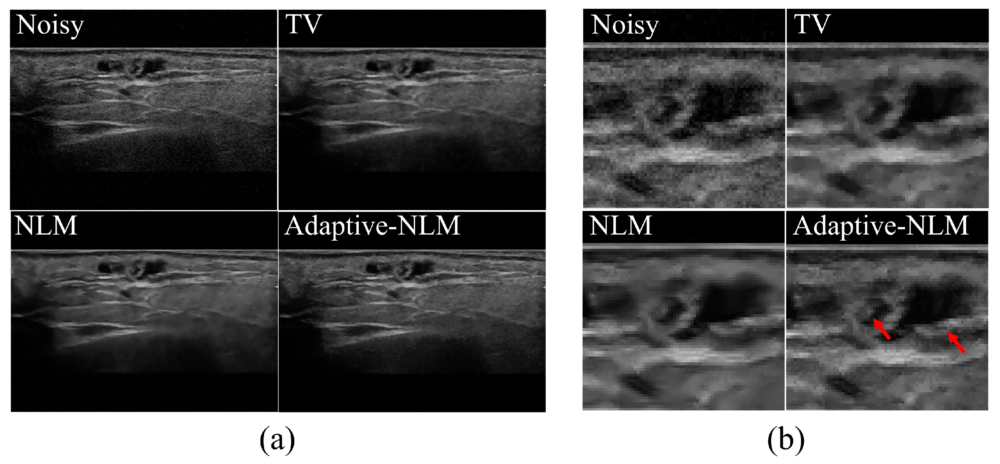 Performance Evaluation of Ultrasound Images Using Non-Local Means Algorithm with Adaptive ...