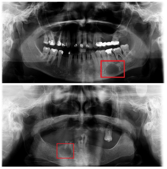 Utilizing Deep Learning for Diagnosing Radicular Cysts