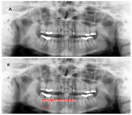 Utilizing Deep Learning for Diagnosing Radicular Cysts