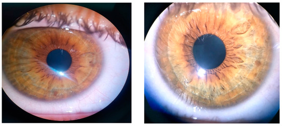 Neurofibromatosis Type 1—Retinal Alterations Detectable with Optical ...