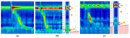 Utilizing Esophageal Motility Tests in Diagnosing and Evaluating ...