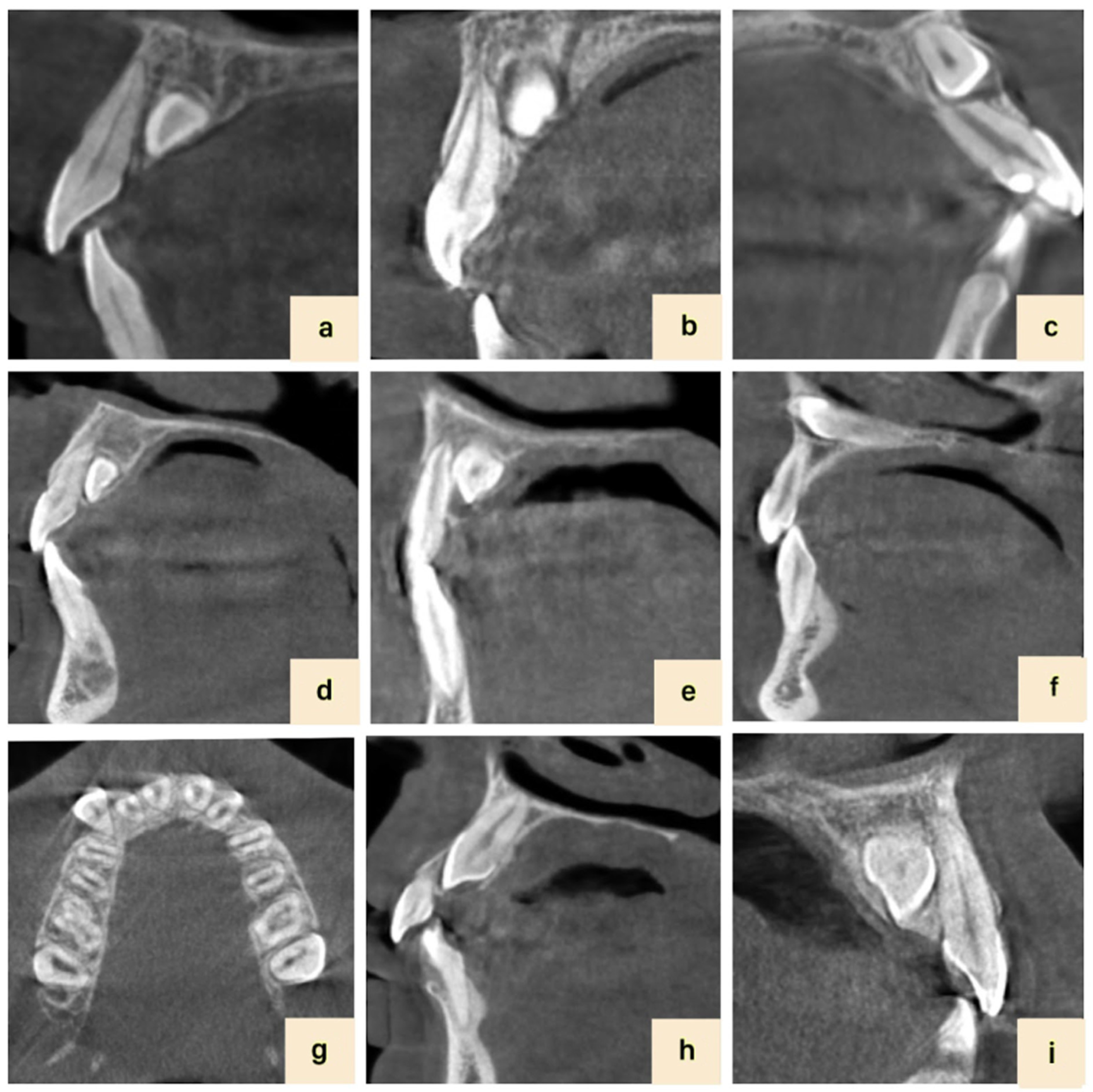Evaluation of the Relationship between Impacted Maxillary Canine Teeth ...