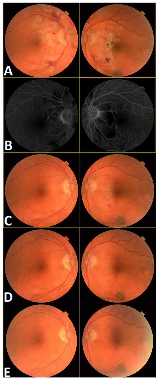 Purtscher Retinopathy Resulting from a Car Crash Accident—Multimodal ...