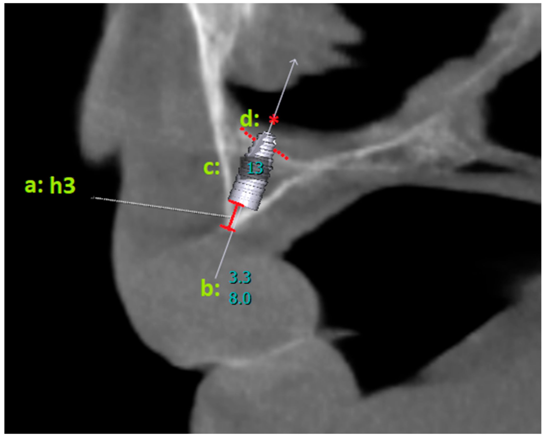 Risk Assessment of Nasal Cavity Perforation in the Maxilla: A Virtual ...