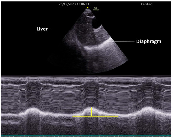 Ultrasonographic Assessment of the Diaphragm