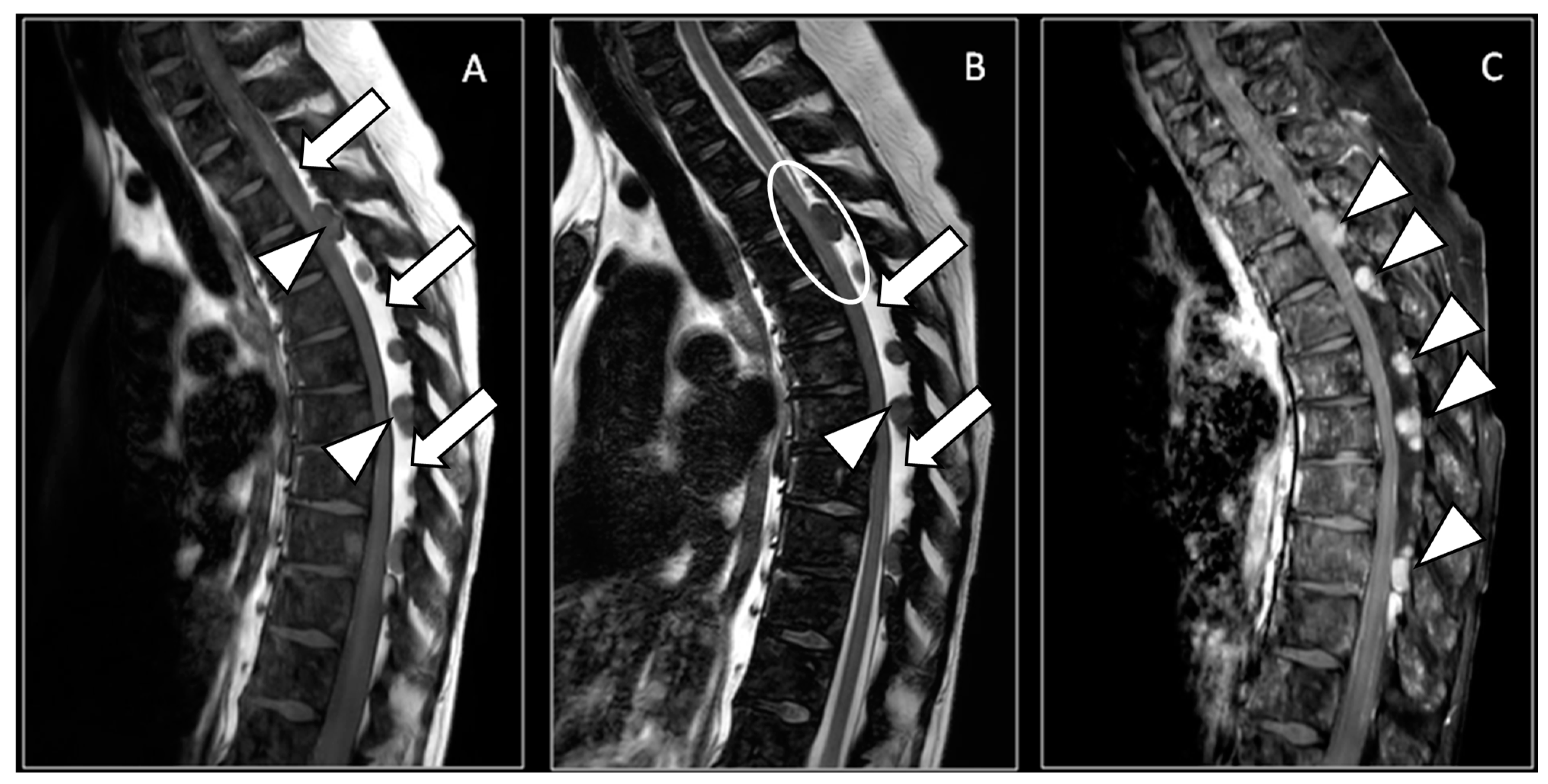 Breast Cancer Leptomeningeal Metastases on Spinal Epidural Lipomatosis