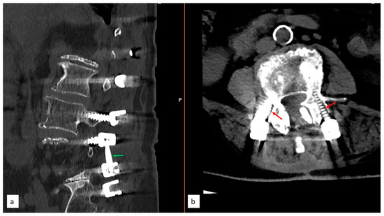 Two-Stage Lumbar Dynamic Stabilization Surgery: A Comprehensive ...