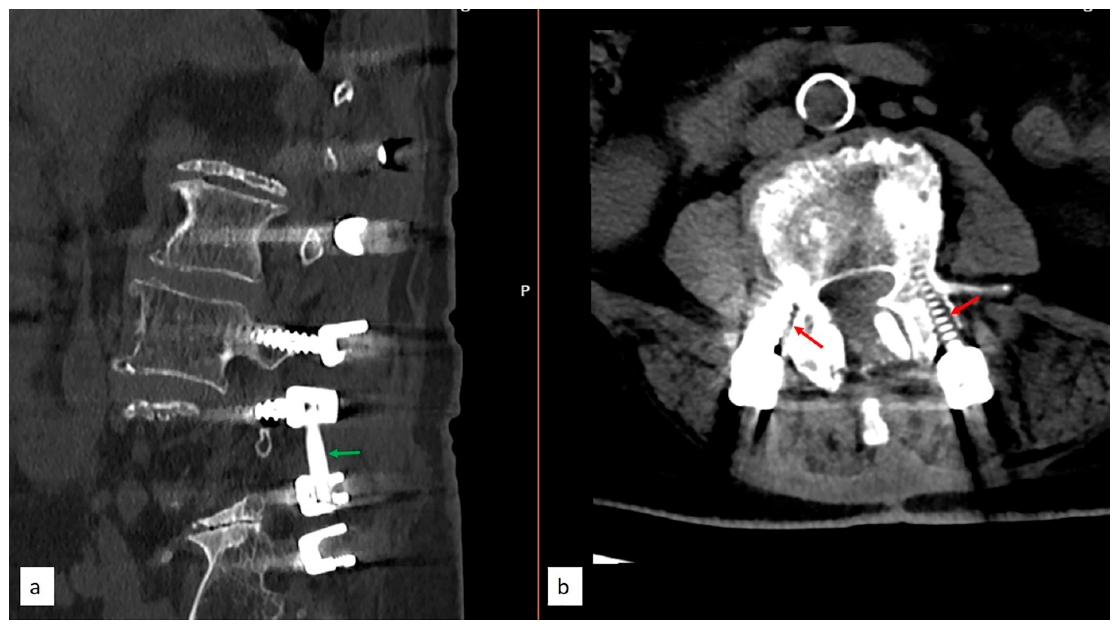 Two-Stage Lumbar Dynamic Stabilization Surgery: A Comprehensive ...