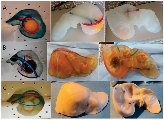 Liver Phantoms Cast in 3D-Printed Mold for Image-Guided Procedures