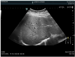 Liver Phantoms Cast in 3D-Printed Mold for Image-Guided Procedures