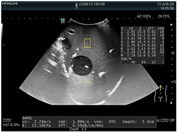 Liver Phantoms Cast in 3D-Printed Mold for Image-Guided Procedures