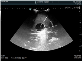 Liver Phantoms Cast in 3D-Printed Mold for Image-Guided Procedures