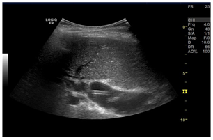 Liver Phantoms Cast in 3D-Printed Mold for Image-Guided Procedures