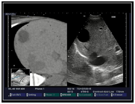 Liver Phantoms Cast in 3D-Printed Mold for Image-Guided Procedures
