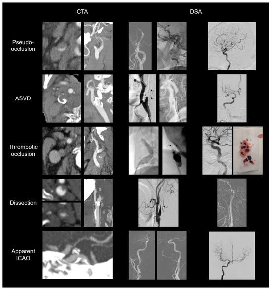 Differentiation of Acute Internal Carotid Artery Occlusion Etiology on ...