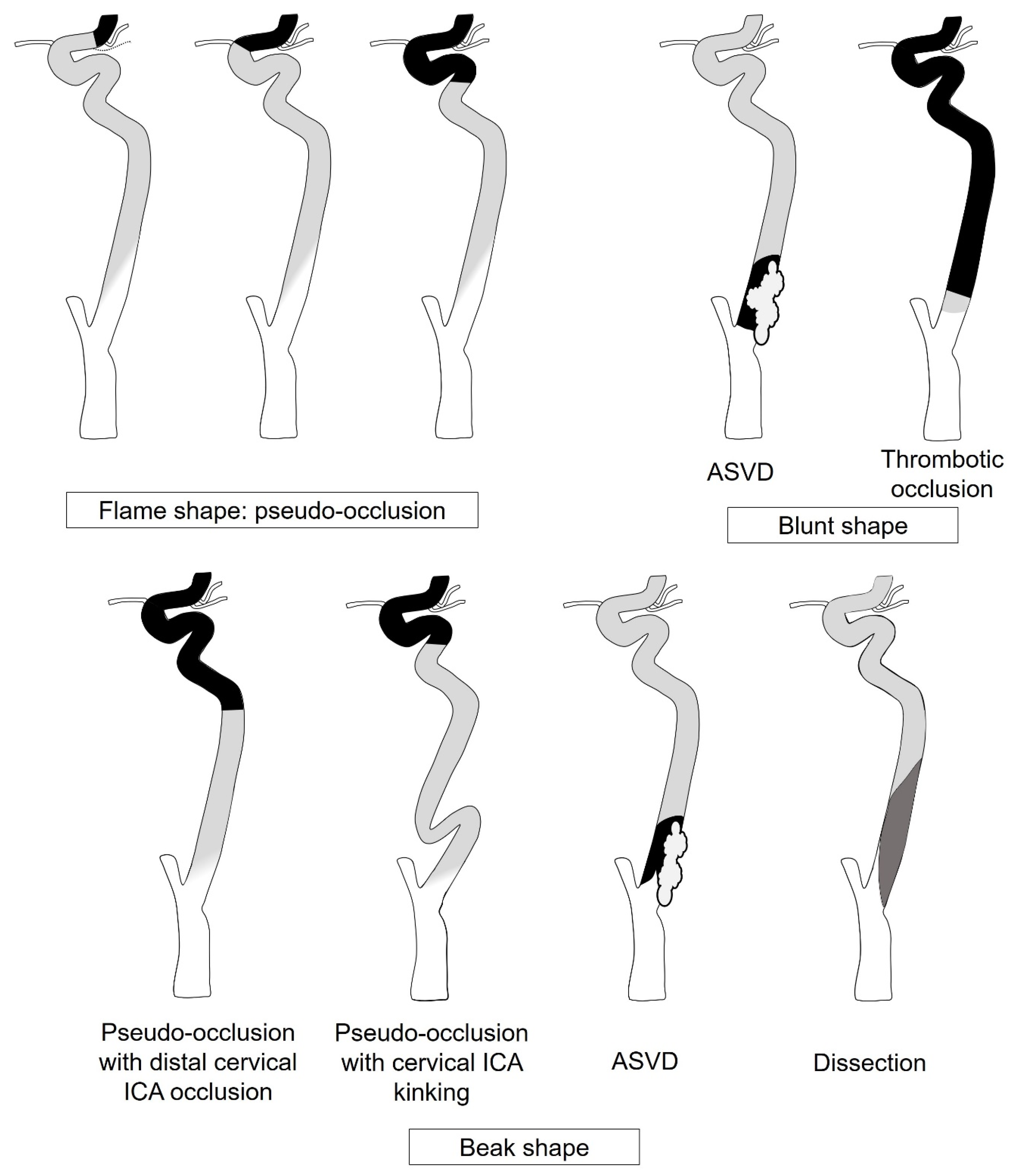 Differentiation of Acute Internal Carotid Artery Occlusion Etiology on ...
