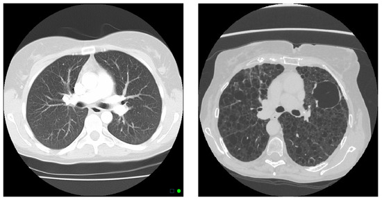 Clinical Trial Validation of Automated Segmentation and Scoring of ...
