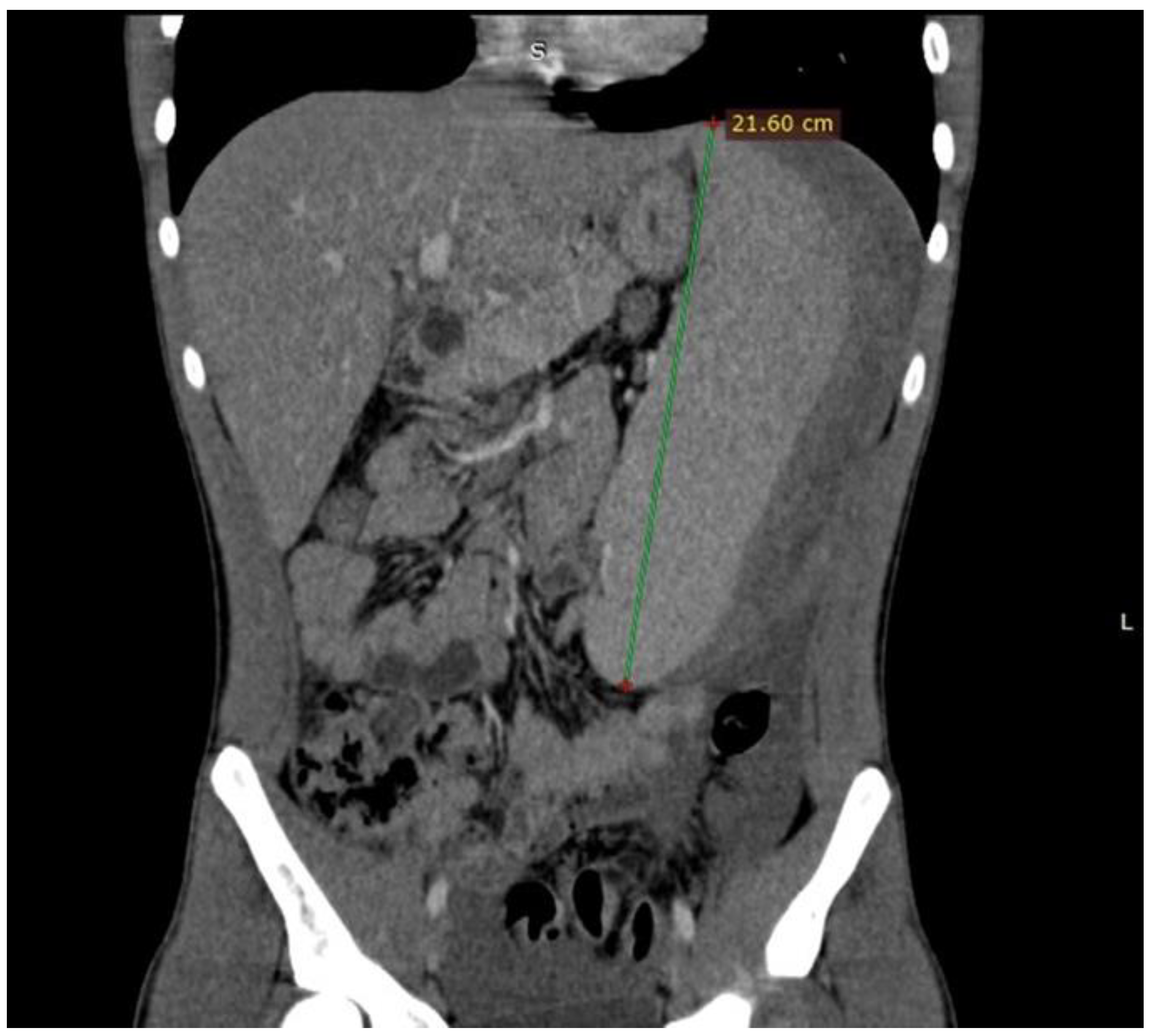Spontaneous Splenic Rupture Secondary to Infectious Mononucleosis