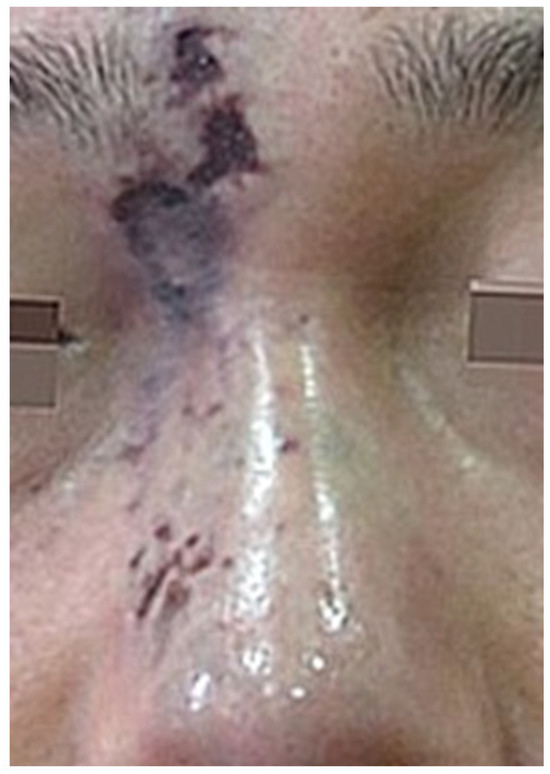 Adverse Effects Associated with Dermal Filler Treatments: Part II ...