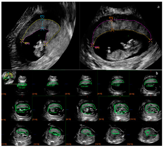 Reference Ranges of 2-Dimensional Placental Biometry and 3-Dimensional ...