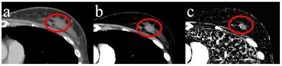 Improvement of Breast Cancer Detection Using Dual-Layer Spectral CT