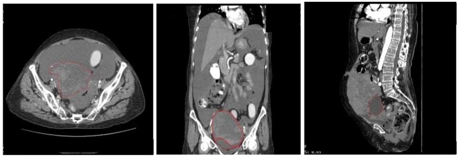Explainable AI for Interpretation of Ovarian Tumor Classification Using ...