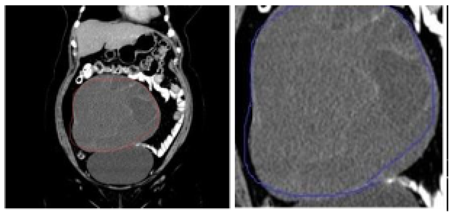 Explainable AI for Interpretation of Ovarian Tumor Classification Using ...