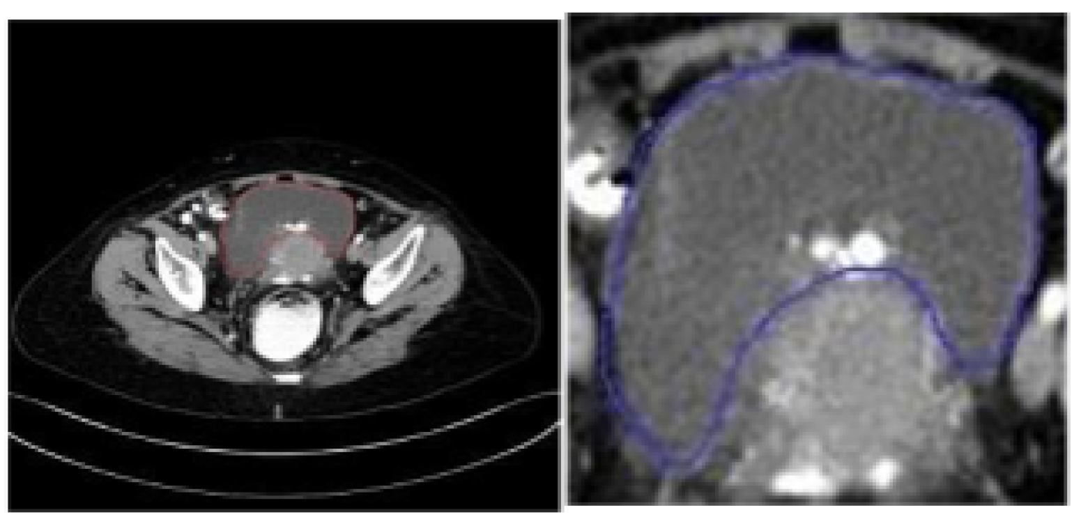 Explainable AI for Interpretation of Ovarian Tumor Classification Using ...