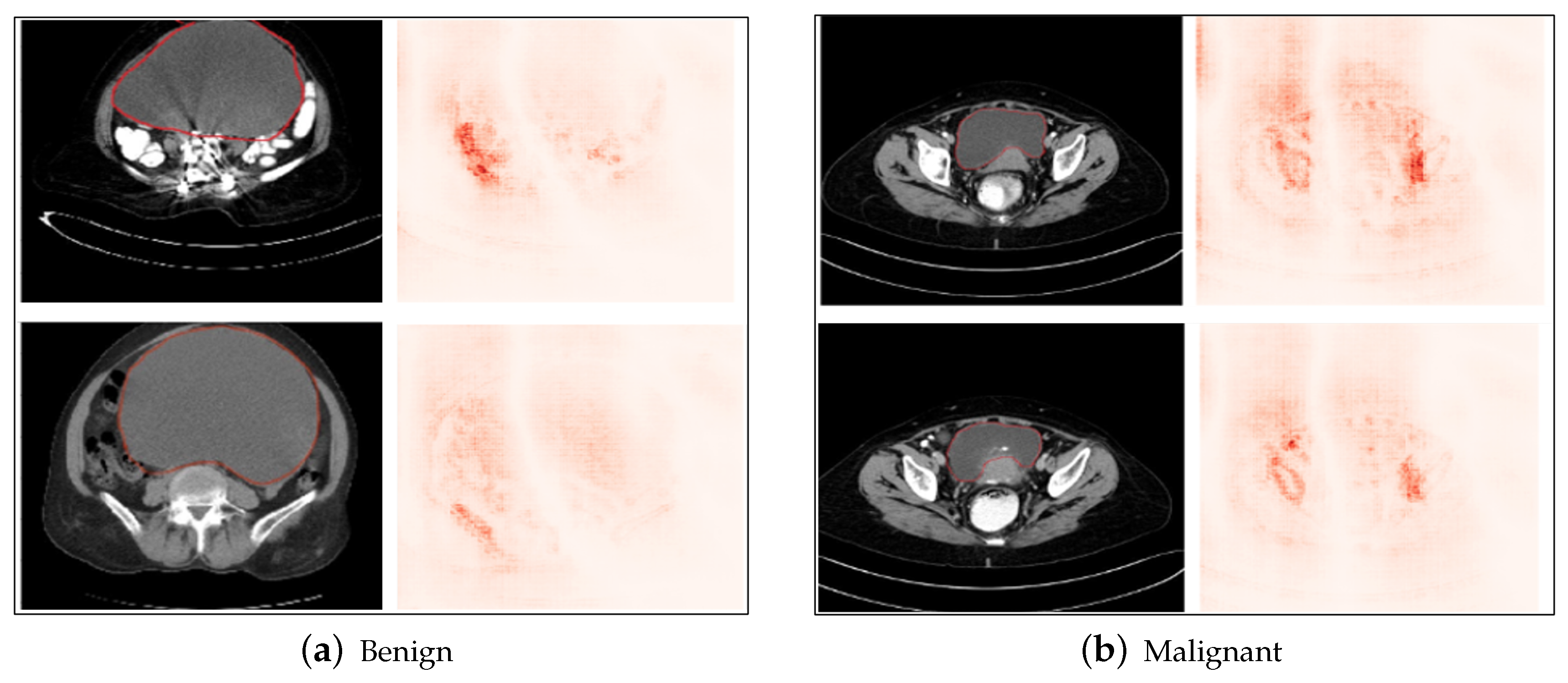 Explainable AI for Interpretation of Ovarian Tumor Classification Using ...