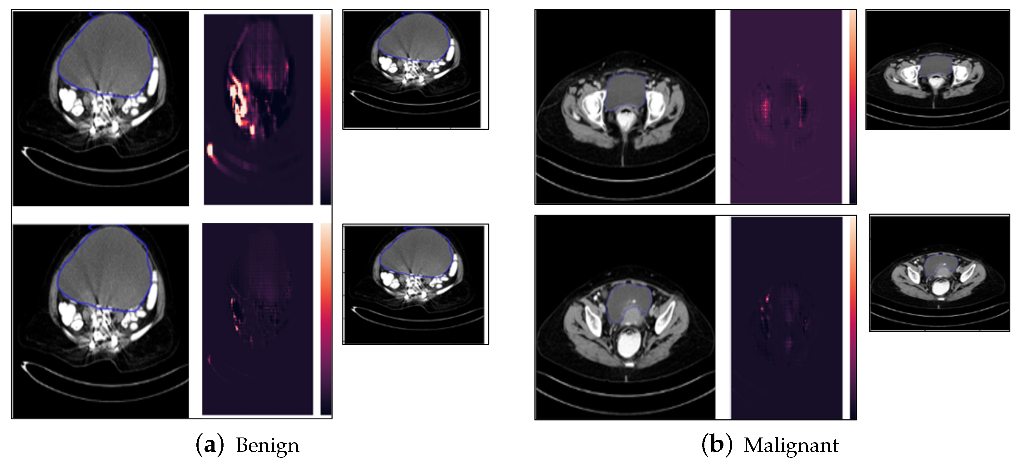 Explainable AI for Interpretation of Ovarian Tumor Classification Using ...