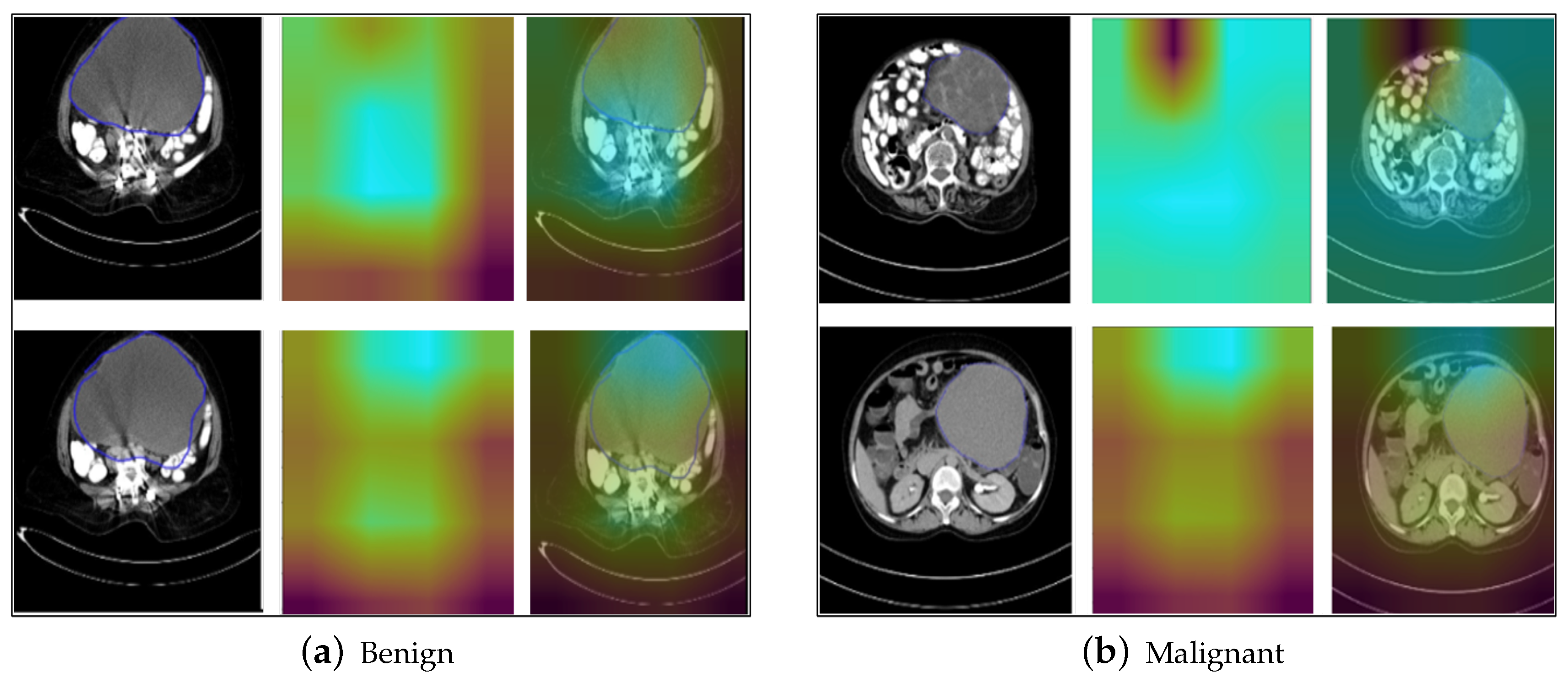 Explainable AI for Interpretation of Ovarian Tumor Classification Using ...