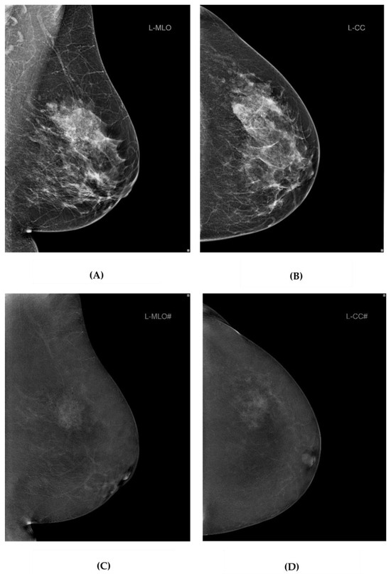 Validation of Contrast-Enhanced Mammography as Breast Imaging Modality Compared to Standard ...