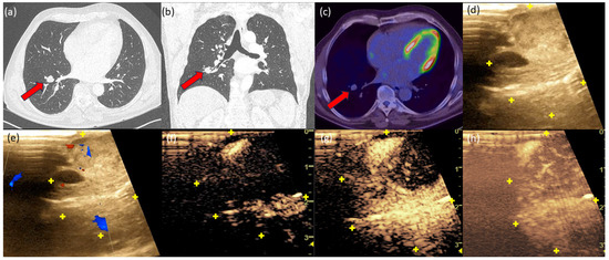 Performance of Intraoperative Contrast-Enhanced Ultrasound (Io-CEUS) in ...
