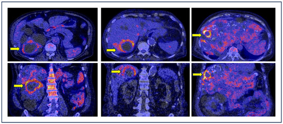 Performance of [18F]FDG PET/CT in Diagnosing Cyst Infections in ...