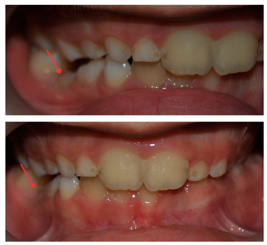 Early Diagnosis and Treatment of Mandibular Second Premolar Impaction ...