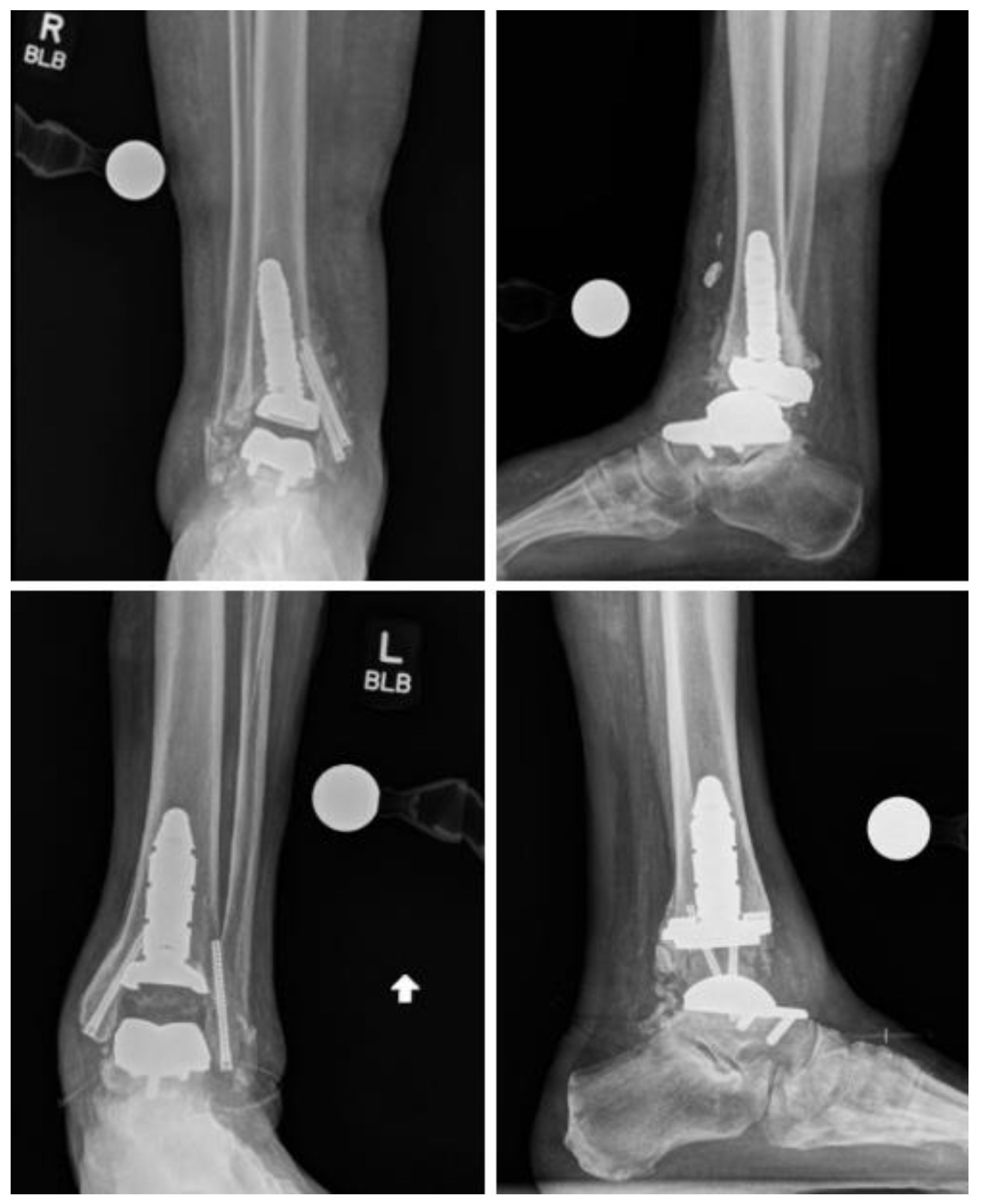 Diagnostics | Free Full-Text | The INVISION Talar Component in Revision Total Ankle Arthroplasty ...