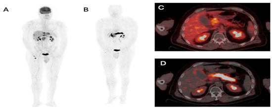 Enhanced Pancreatitis Detection: FAPI PET/CT Emerging Utility in ...