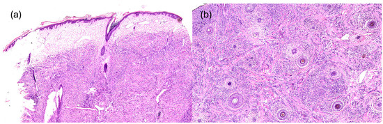 Diagnosis and Management of Scalp Metastases: A Review
