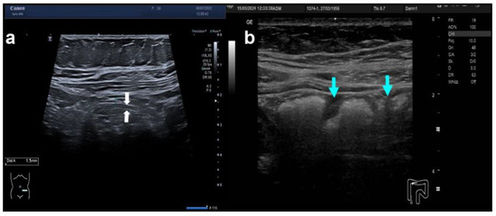 Role of Intestinal Ultrasound for IBD Care: A Practical Approach