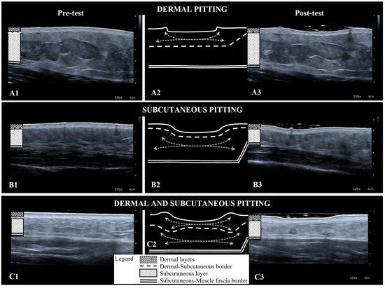 Pitting Is Not Only a Measure of Oedema Presence: Using High-Frequency ...