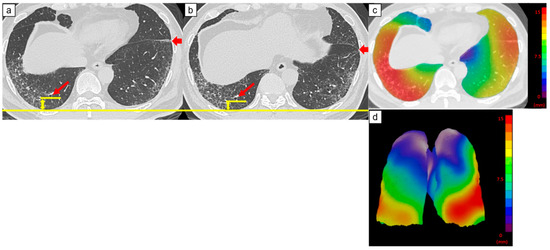 Evaluation of Progressive Architectural Distortion in Idiopathic ...